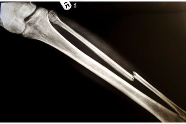 Bone Fracture Injuries » Abrahamson & Uiterwyk Injury Lawyers Bone Fracture Injuries » Abrahamson & Uiterwyk Injury Lawyers