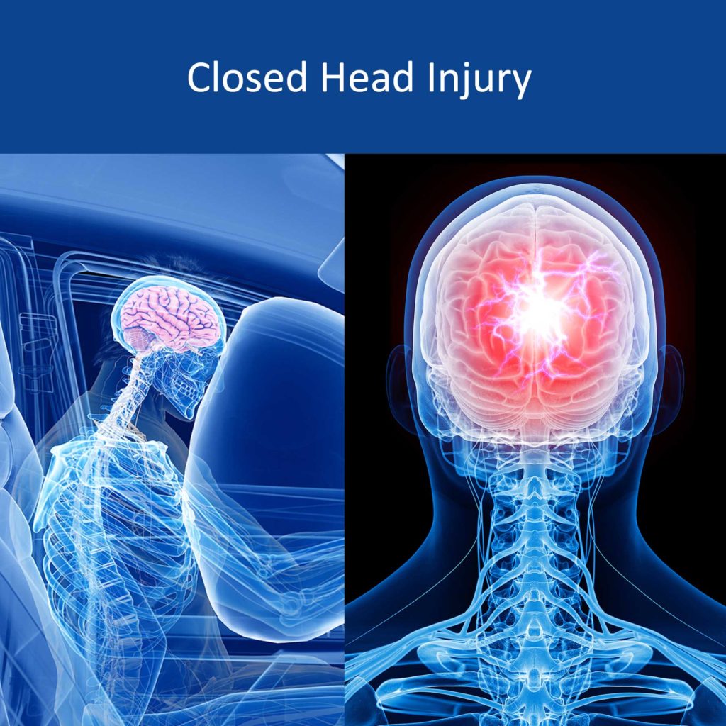 24/7 Tampa Car Accident Lawyers & Personal Injury Attorneys Near You ...